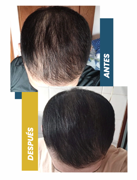 Caída del cabello De las causas al tratamiento… – Revista Beauty & Health